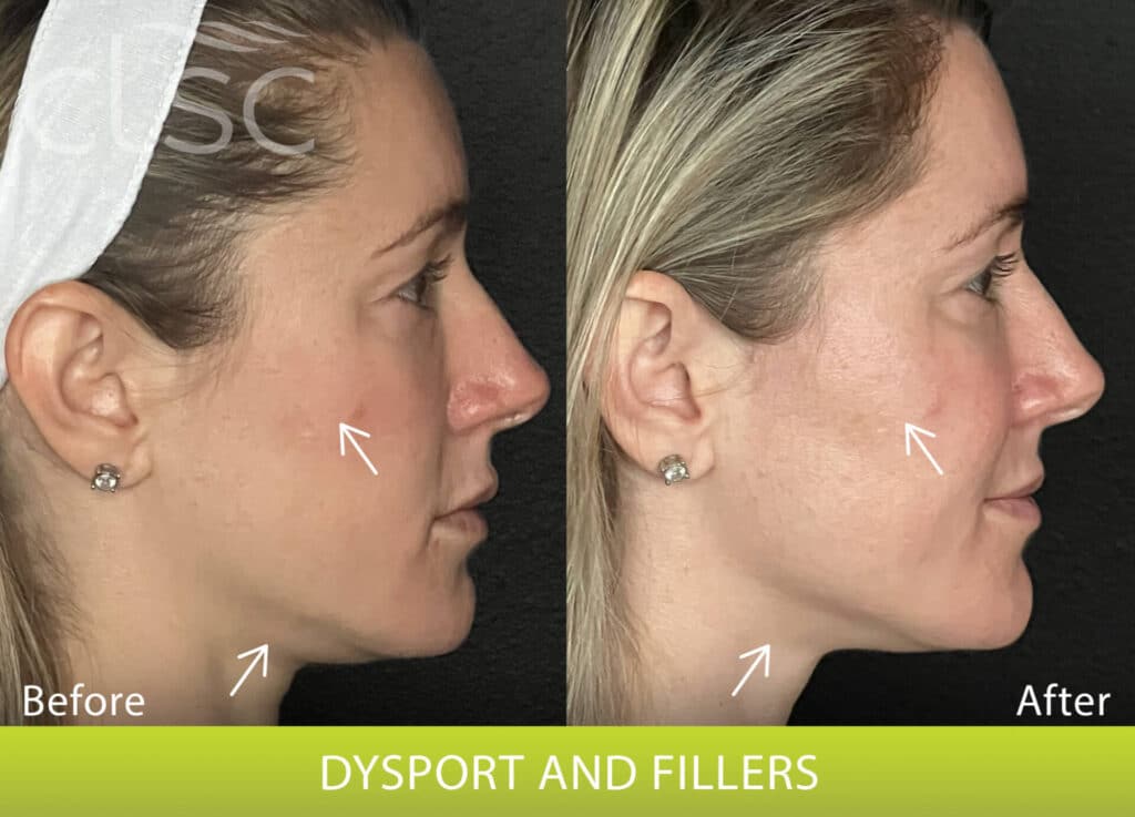 Fillers - Before & After | Columbia Laser Skin Center