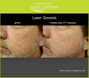 Laser Genesis - Scars, Large Pores, Skin Texture & Rosacea | Columbia