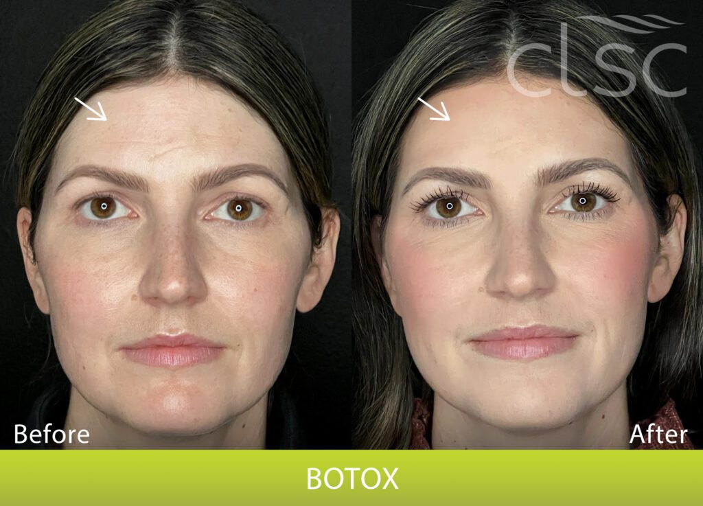 Botox in The Dalles, OR | Columbia Laser Skin Center
