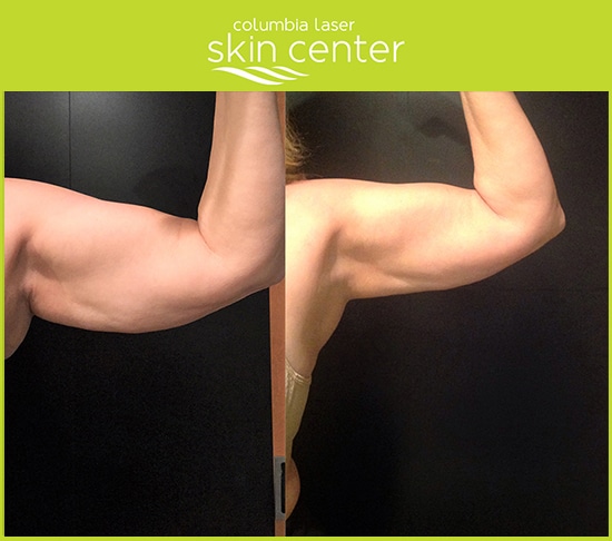 Body Contouring in The Dalles, OR | Columbia Laser Skin Center