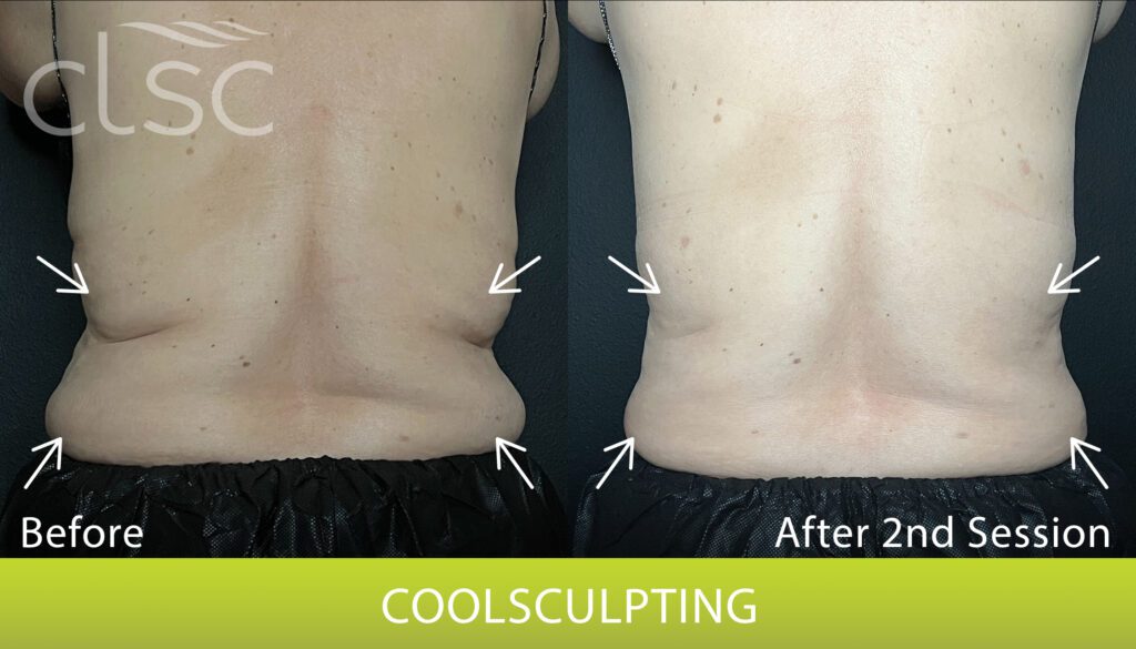 CoolSculpting - Before and After | Columbia Laser Skin Center