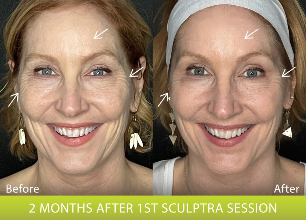 Sculptra - Before & After | Columbia Laser Skin Center