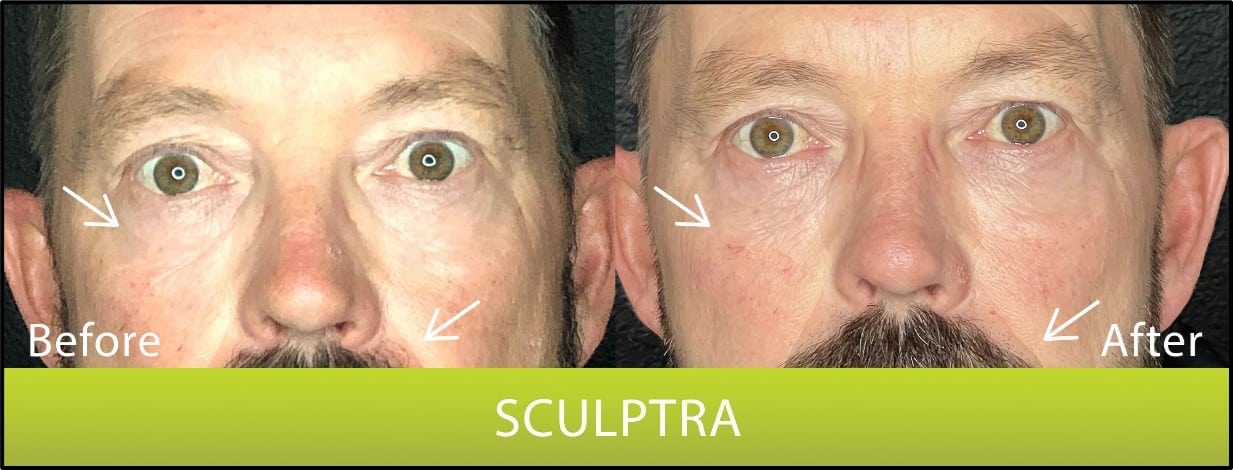 The Science Behind Sculptra | Columbia Laser Skin Center