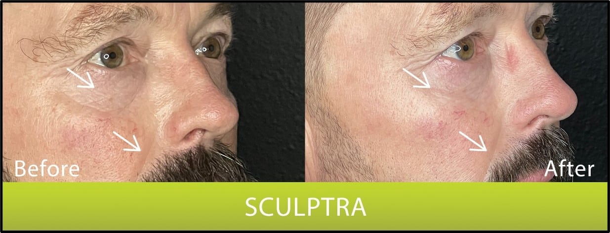 The Science Behind Sculptra | Columbia Laser Skin Center