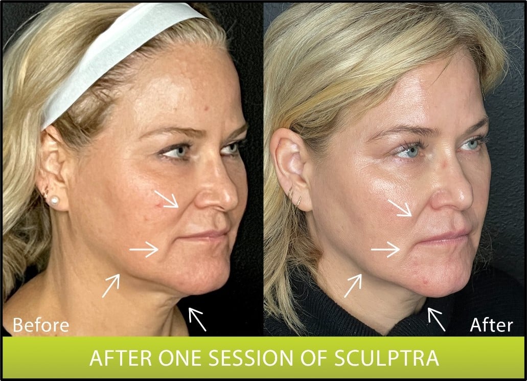 The Science Behind Sculptra | Columbia Laser Skin Center