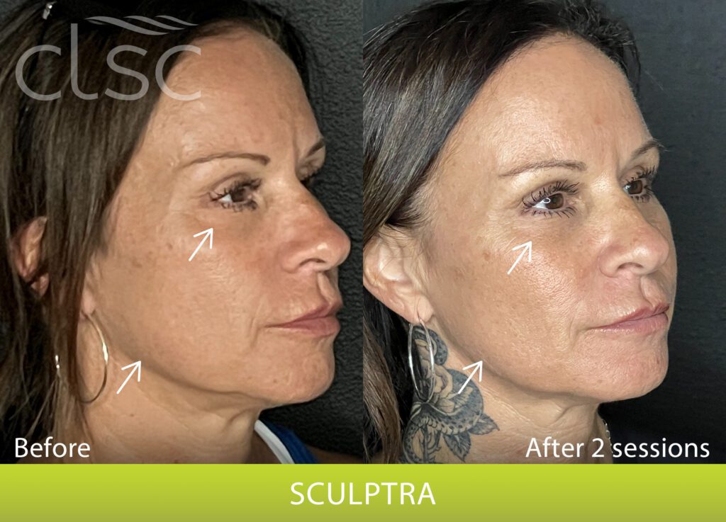 Sculptra - Before & After | Columbia Laser Skin Center