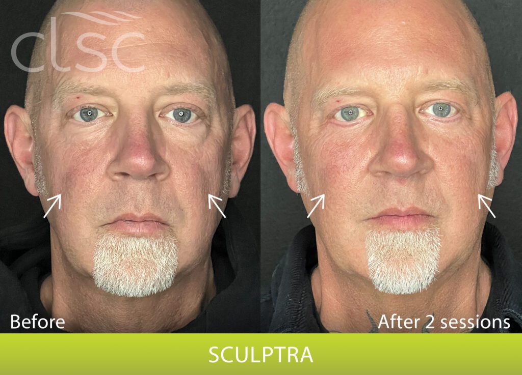 Sculptra - Before & After | Columbia Laser Skin Center