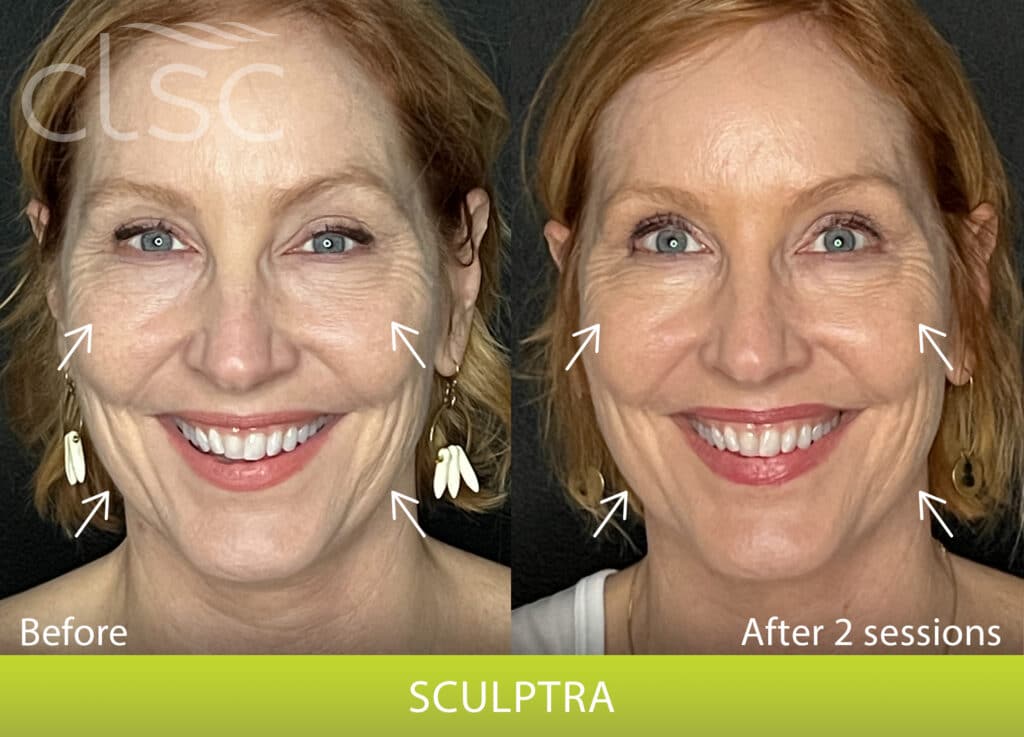 Sculptra - Before & After | Columbia Laser Skin Center