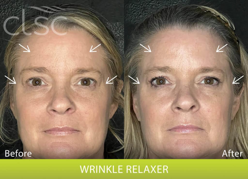 Wrinkle Relaxers - Before & After | Columbia Laser Skin Center