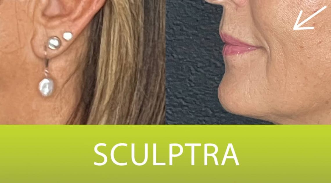 Sculptra in The Dalles, OR | Columbia Laser Skin Center