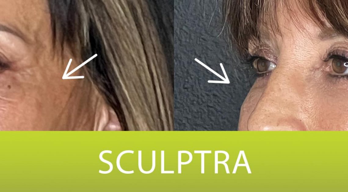 Sculptra in The Dalles, OR | Columbia Laser Skin Center
