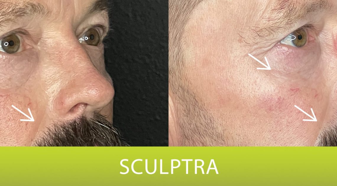 Sculptra in The Dalles, OR | Columbia Laser Skin Center
